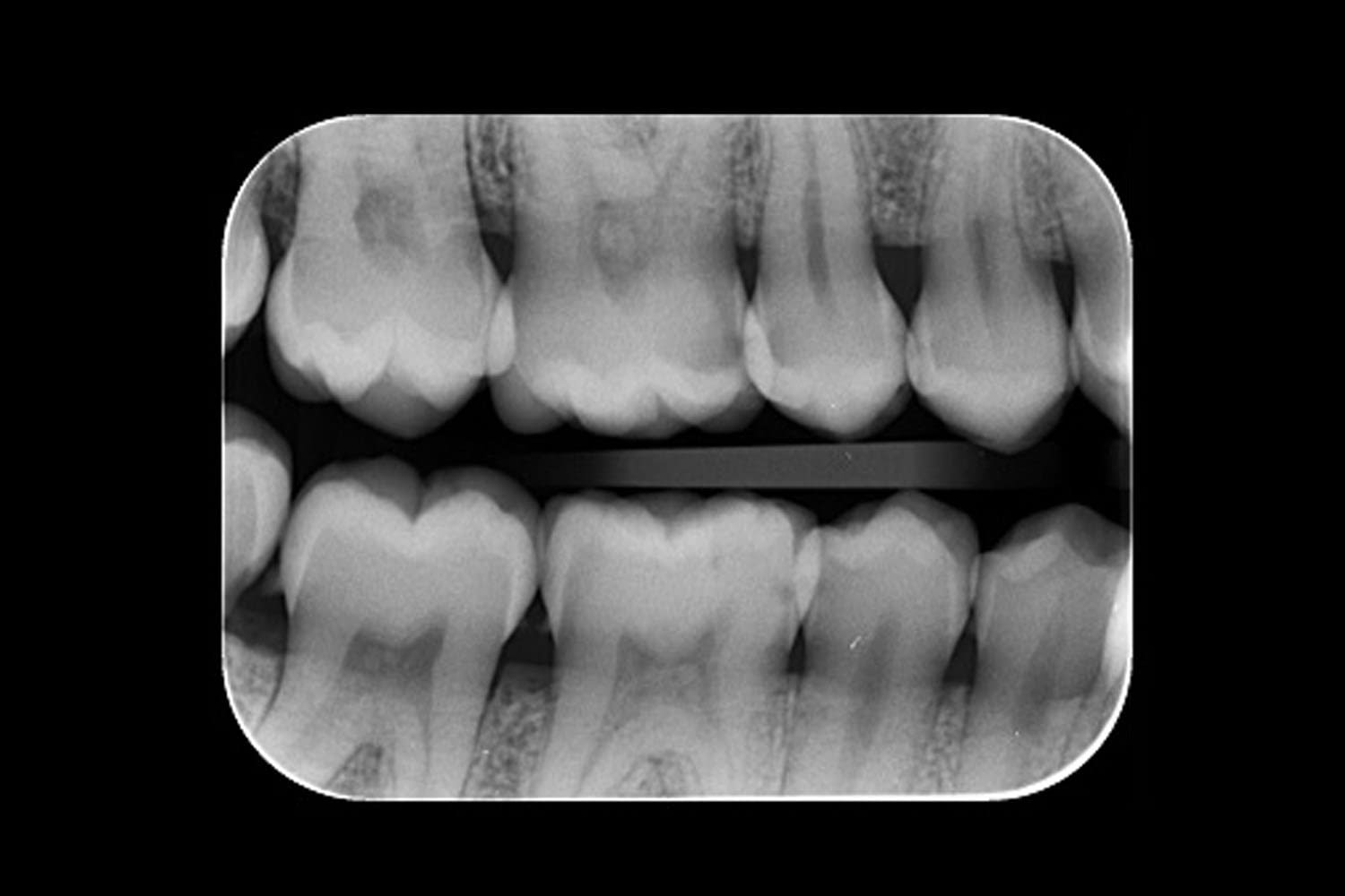 Radiografie Bite-Wing - Clinica Dr. Mariuta - Medestetic - Stomatologie ...